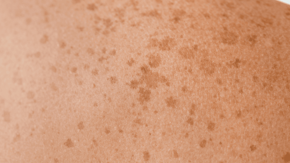 Apa Itu Lentigo? Ini Gejala, Penyebab dan Cara Mengatasinya